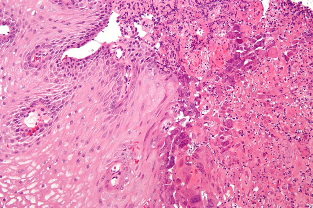 Esofagite Eosinofílica - O que é, Sintomas e Tratamentos | Dicas de Saúde