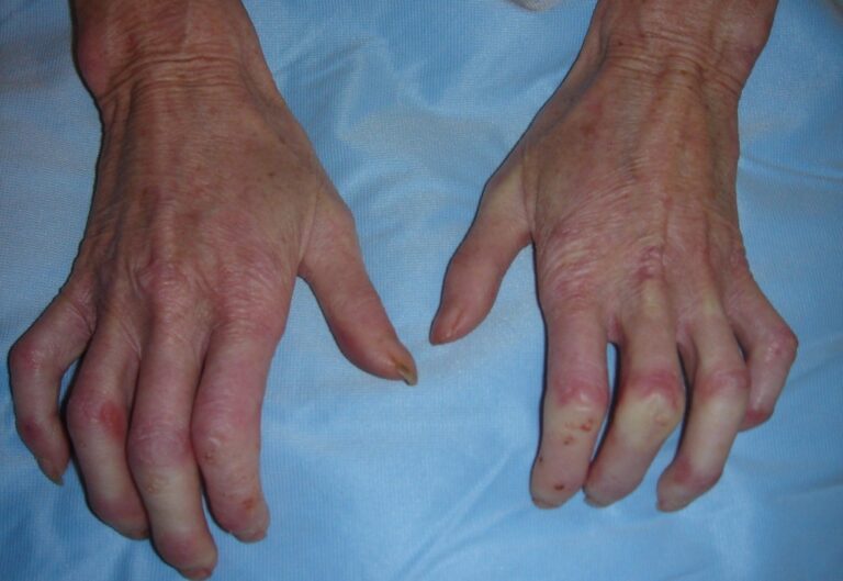 Síndrome de CREST - O que é, Causas, Sintomas e Tratamentos!