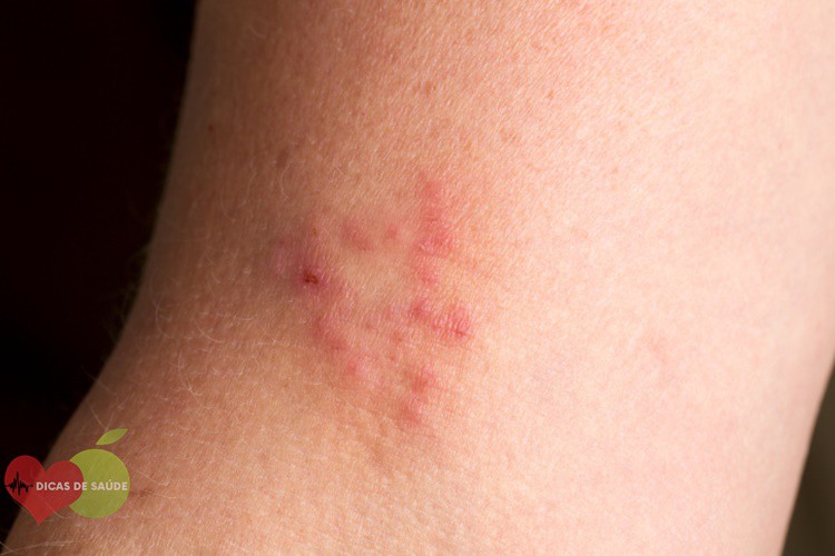 Candidíase na Pele - Causas, Sintomas e Tratamentos | Dicas de Saúde