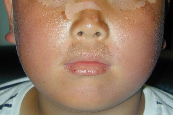 Eritema Infeccioso - O que é, Causas e Tratamentos | Dicas de Saúde