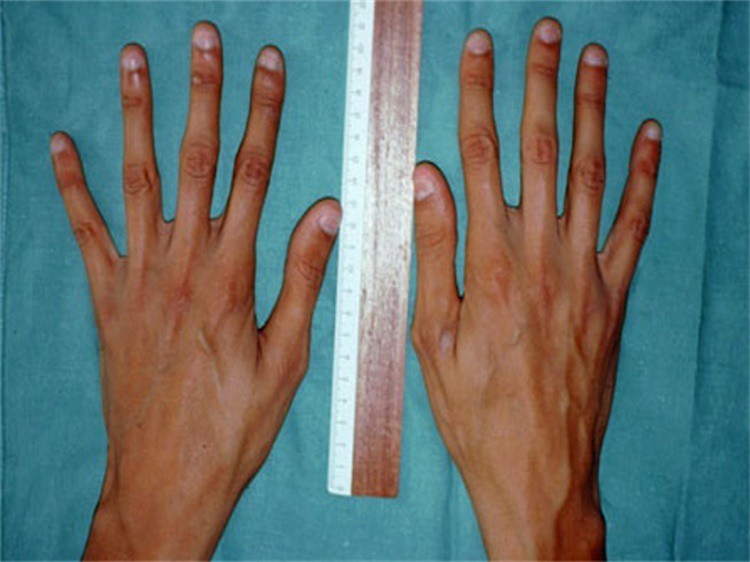 Homocistinúria - Causas, Sintomas e Tratamentos que Devemos Saber ...