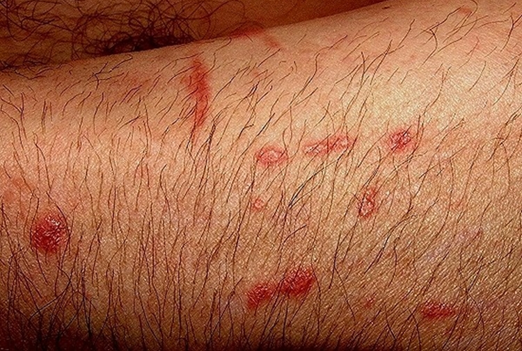 Líquen Plano - O que é, Causas, Sintomas e Tratamentos 【Atualizado】