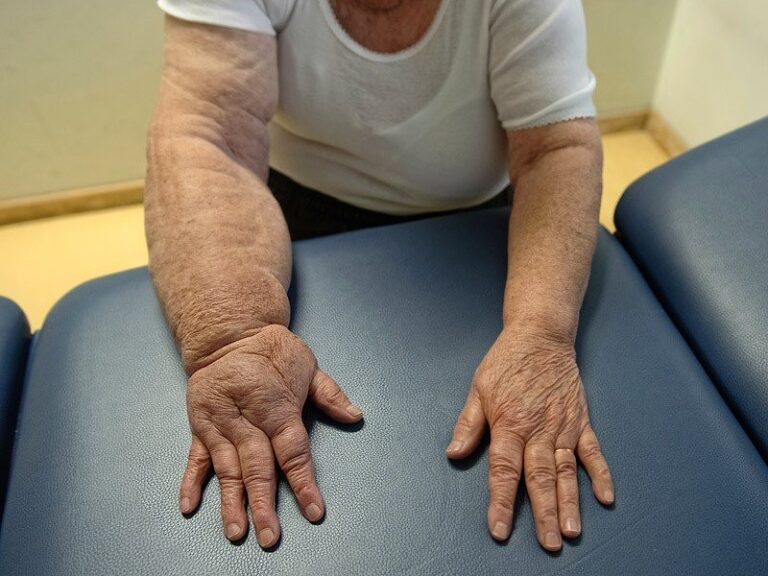 As 2 Principais Causas da Lipedema | Dicas de Saúde