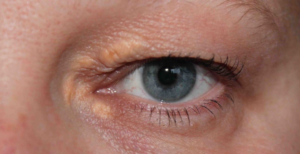 Meibomite - O que é, Causas, Sintomas e Tratamentos 【ATUALIZADO】