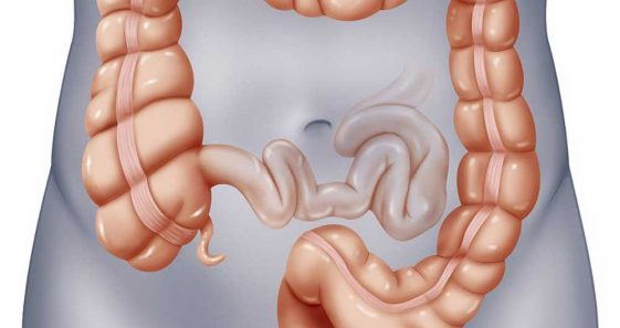 Pólipos Colônicos - Causas, Sintomas e Tratamentos | Dicas de Saúde