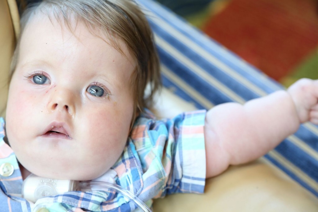 Sindrome De Moebius Causas - RETOEDU