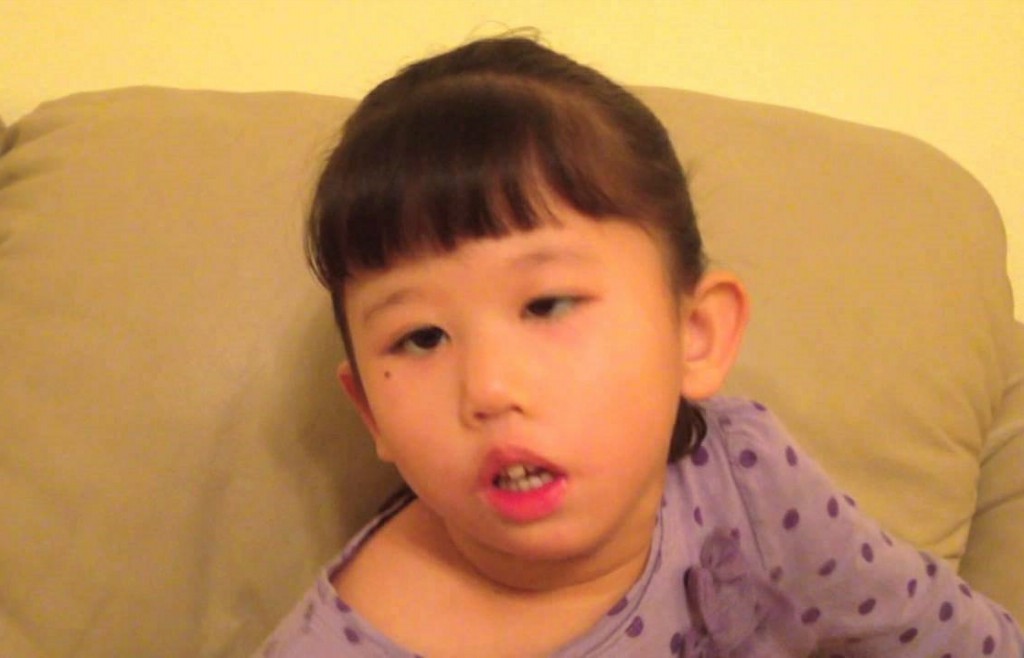 Síndrome de Moebius - O que é, Causas, Sintomas e Tratamentos | Dicas ...