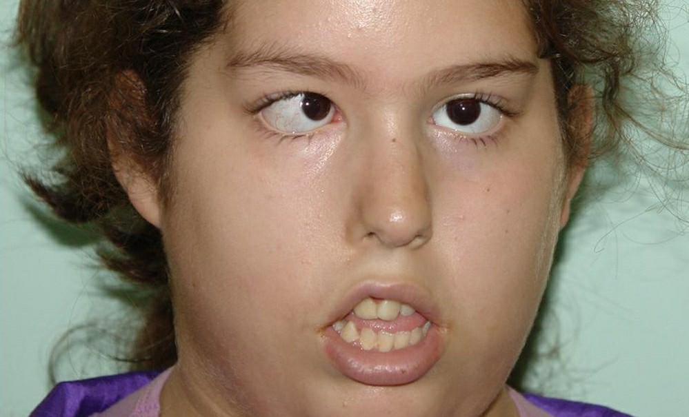 Síndrome de Moebius - O que é, Causas, Sintomas e Tratamentos | Dicas ...