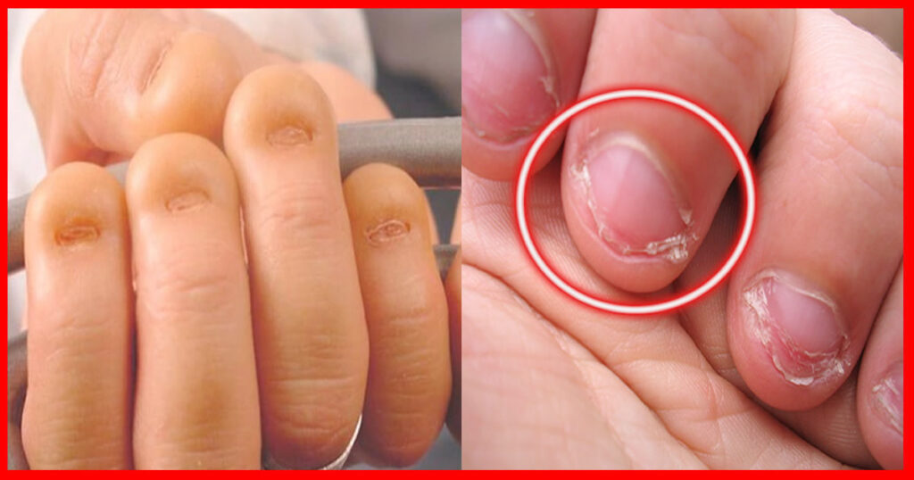 4 dicas para parar de roer as unhas para sempre | Dicas de Saúde