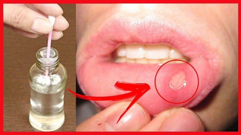 4 remédios caseiros para tratar afta | Dicas de Saúde