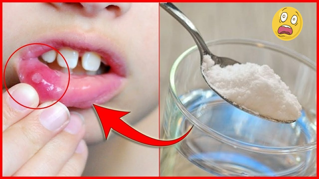 Os 5 Remédios Caseiros Para Tratar Afta Naturalmente | Dicas de Saúde