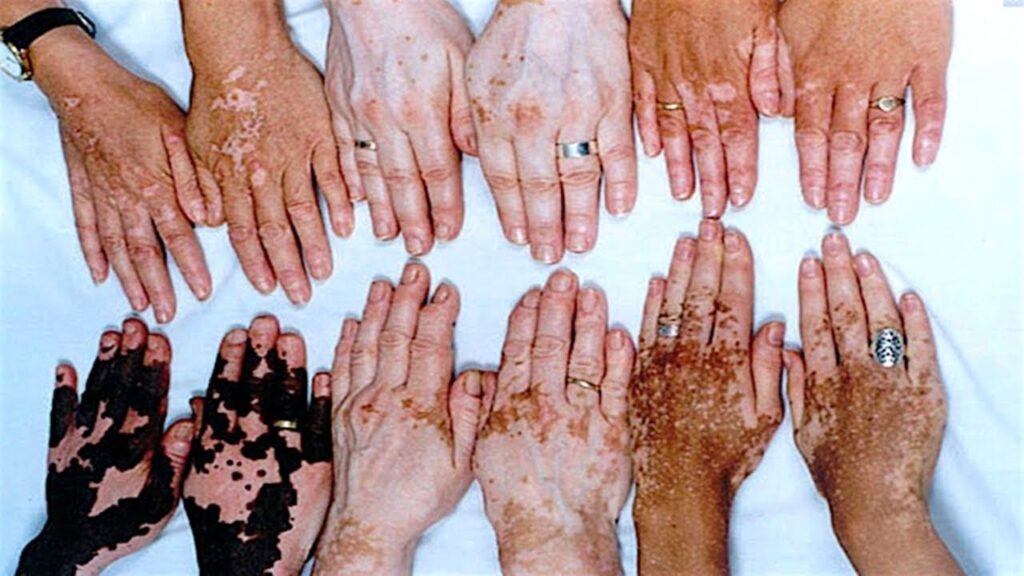 Vitiligo - o que é, causas, sintomas e tratamentos! | Dicas de Saúde