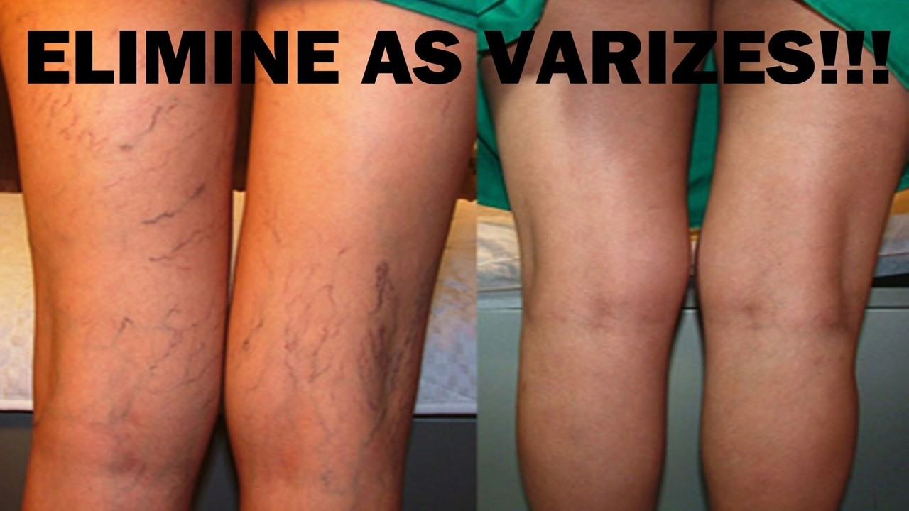 Receitas caseiras para eliminar varizes em poucos dias | Dicas de Saúde