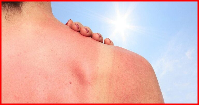 Remédio caseiro para queimaduras na pele causadas pelo sol!