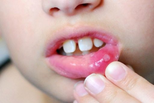 6 remédios caseiros para curar afta em 5 minutos | Dicas de Saúde