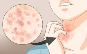 Impingem - sintomas e remédios naturais! | Dicas de Saúde